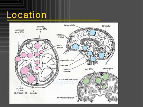Meningioma