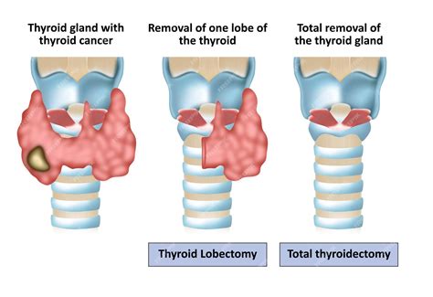 Premium Vector Thyroid Surgery