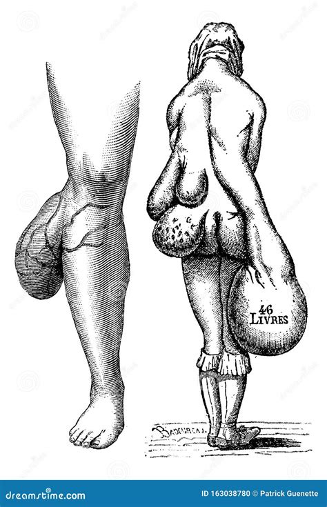 Multiple Lipomas Stock Illustrations 1 Multiple Lipomas Stock Illustrations Vectors And Clipart