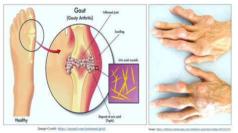 Gout Neck Stiffness Gout Diagnosis Treatment And Steps To Take Nyjfa