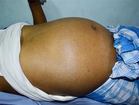 Ascites Why It Happens And How Its Treated