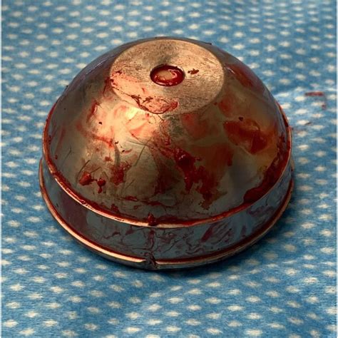 The Titanium Acetabular Shell Without Evidence Of Back Side Wear