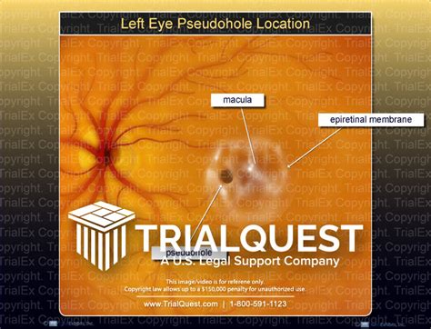 Left Eye Pseudohole Location Trial Exhibits Inc