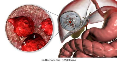 Echinococcus Multilocularis Zyste
