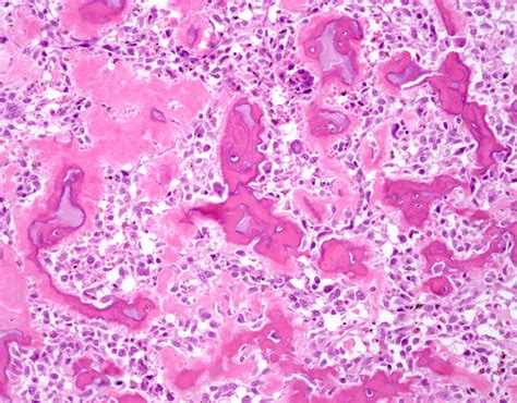 Osteoblastic Osteosarcoma Light Micrograph Stock Image C0577543 Science Photo Library