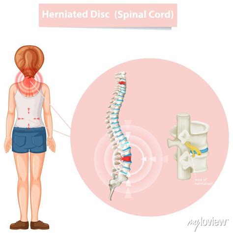 Diagram Showing Herniated Disc Posters For The Wall • Posters Clip