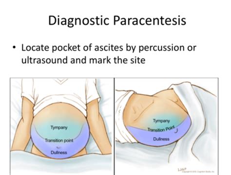 Paracentesis Flashcards Quizlet