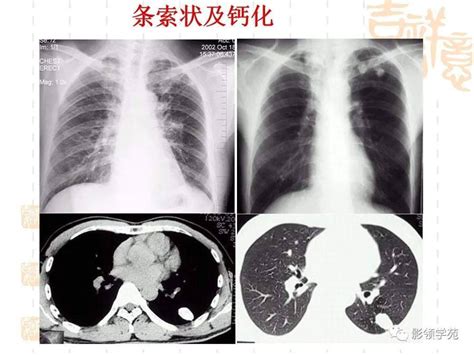 肺部常见疾病的影像诊断 搜狐大视野 搜狐新闻