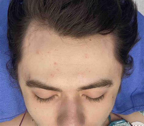 The Outcomes Of Temporal Reduction Surgery For Head Width Reshaping A Patient Example