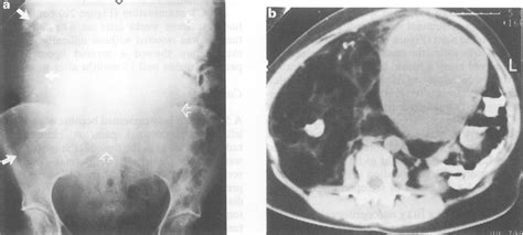 A Plain Abdominal Radiograph Showing A Lucent Area On The Right Download Scientific Diagram