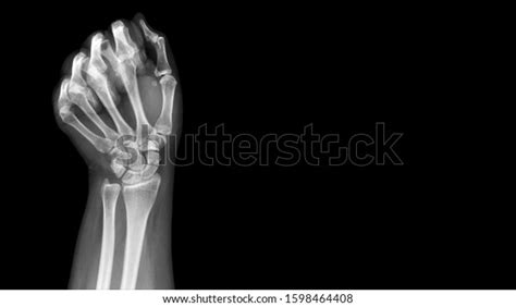 Scaphoid Bone