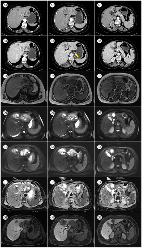 A1a3 Arterial Phase Ct B1b3 Venous Phase Ct The Yellow Arrows