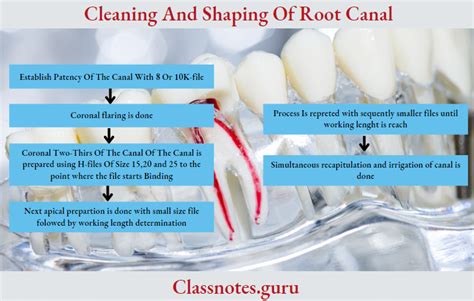 Cleaning And Shaping Of Root Canal Question And Answers Class Notes