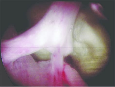 Urethroscopy Giant Prostatic Urethral Calculus With Prostate