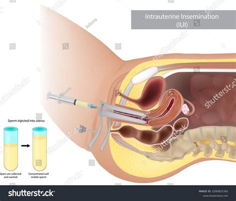 Schematic Illustration Artificial Insemination Intrauterine