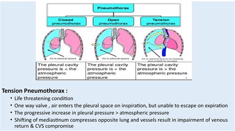 Pneumothorax Ppt Topic Presentation Pptx Lung And Respiratory