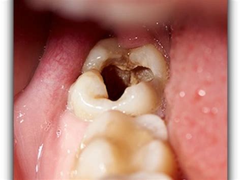 A Ginormous Cavity General Dentistry Artistry In Dentistry