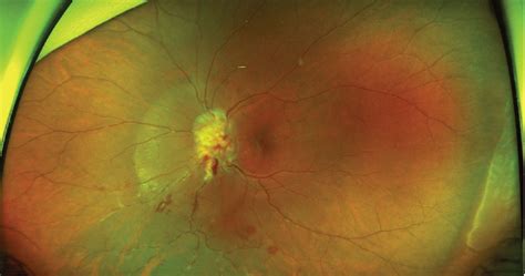 An Update On Sarcoid Uveitis