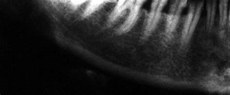 Mci Category C1 Endosteal Margin Of The Cortex Is Sharp And Even On