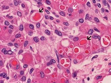 Meningiomas Pathology Definition Overview Etiology