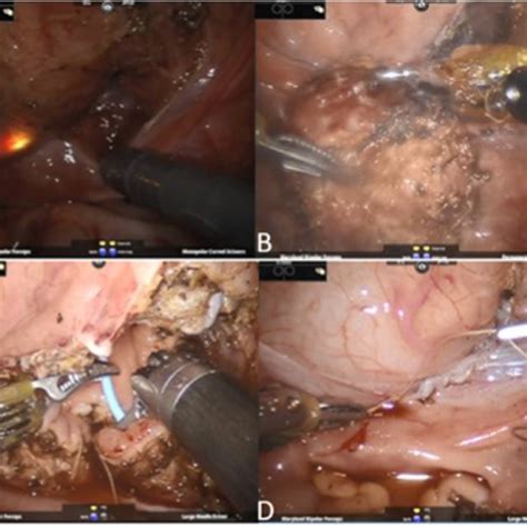 A Demonstration Of Normal Bladder Mucosa Adjacent To The Tumor Download Scientific Diagram