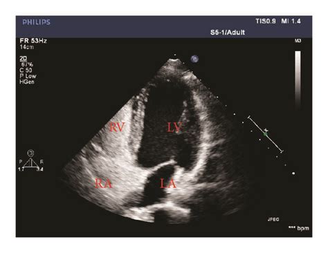 Semiquantitative Grading Of A Patent Foramen Ovale Right To Left Shunt