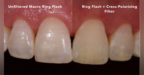 Cross Polarized Reflective Light Dental Photography The Silver Bullet Of Tooth Shade Selection
