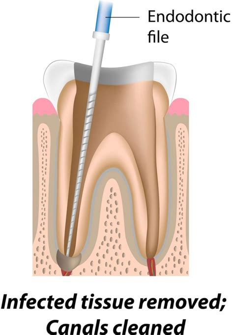 Tooth Root Canal Endodontics File Southlake Endodontics