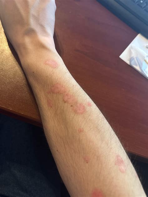 No Insurance Severe Psoriasis Breakout Rpsoriasis