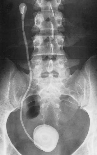 Complications Of Ureteral Stent Placement Radiographics