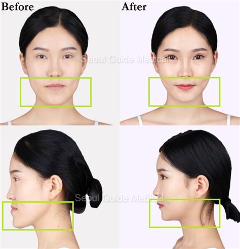 Before And After Double Jaw Surgery Seoul Guide Medical
