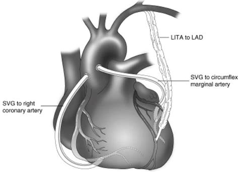 Things You Should Know About Heart Surgery Cvskl