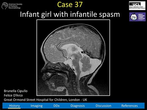 Infant Girl With Infantile Spasm American Society Of Pediatric