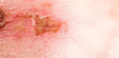 Hydrochloric Acid On Skin