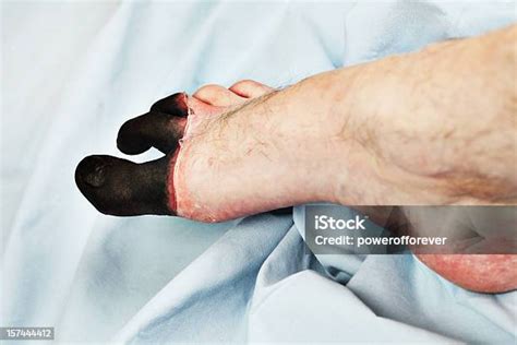 Third Degree Frostbite To Toes Stok Fotoğraflar And Soğuk ısırması‘nin