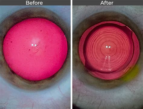 Cataract Before And After Pictures In Los Angeles