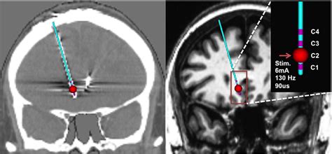 Figure 1 From Mapping The Depression Switch During Intraoperative Testing Of Subcallosal
