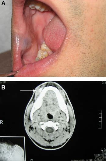 Hemangiomas Of The Head And Neck With Phleboliths Clinical Features Diagnostic Imaging And