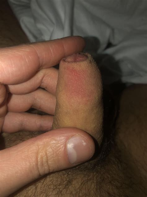 Red Rash On Penis Rbalanitis