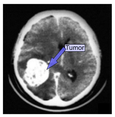 A Review Of Recent Advances In Brain Tumor Diagnosis Based On Ai Based Classification