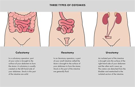Urostomy Stoma