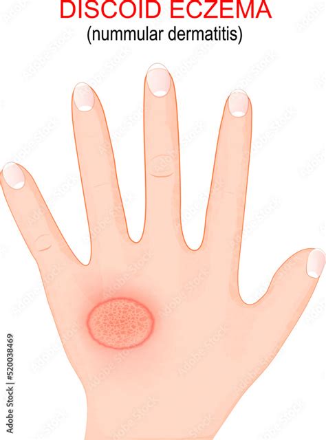 Nummular Dermatitis Discoid Eczema Stock Vector Adobe Stock Nummular Dermatitis Discoid Eczema Stock Vector Adobe Stock
