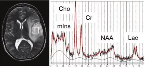 A Single Voxel Mr Spectroscopy Scan Of A Low Grade Astrocytoma It