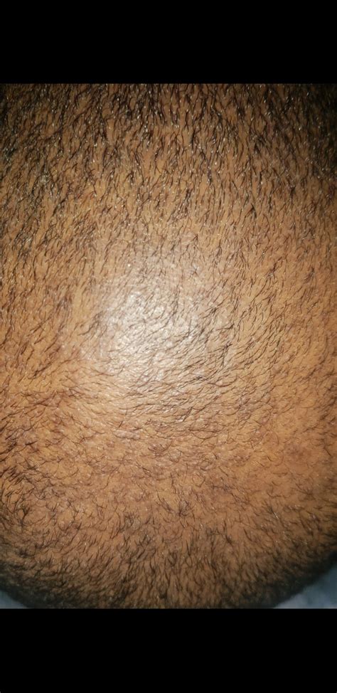 Is This Folliculitis Ive Had This For 2 Months Started As 3 Small