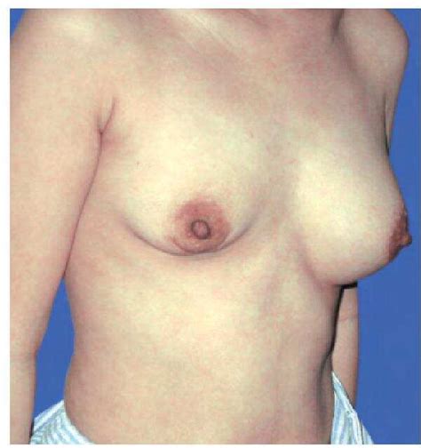 第五节 术后感染 外科图谱 医学