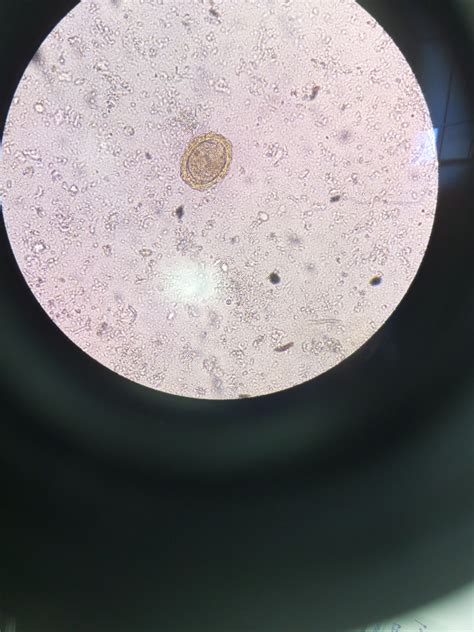 Ascaris Lumbricoides Stool Microscopy Specimen Stool Stool Microscopy Is A Diagnostic Test