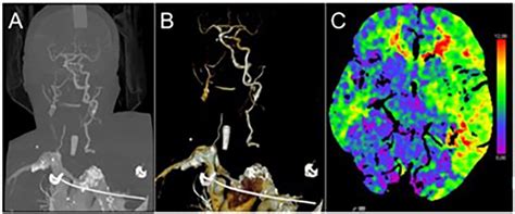 Schematic Illustration Of The Arterial Cannulation And The Cerebral Download Scientific Diagram