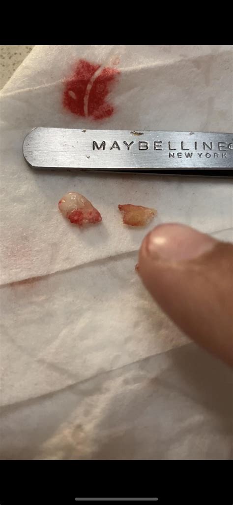 Cyst On My Head Had A Head” And I Squeezed It This Came Out The Hole