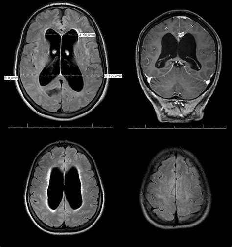 Hydrocephalus Mri