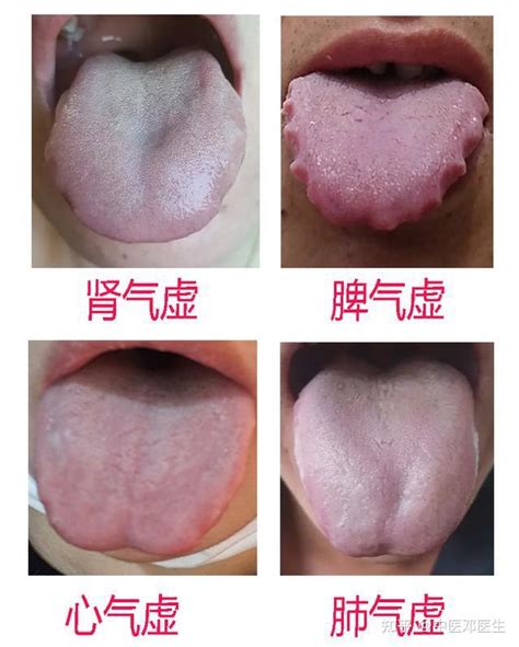 气虚？到底什么是气虚呢？ 知乎